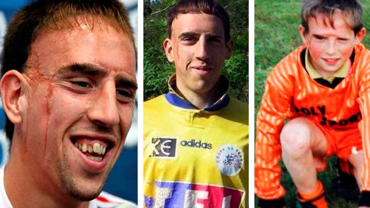 Franck Ribéry y su trágica historia del origen de su cicatriz en el rostro